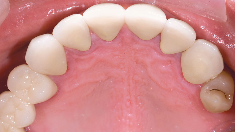 Captek Bridge & Implant™ Expands Clinical Indications