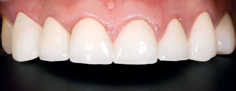 Captek Bridge & Implant™ Expands Clinical Indications