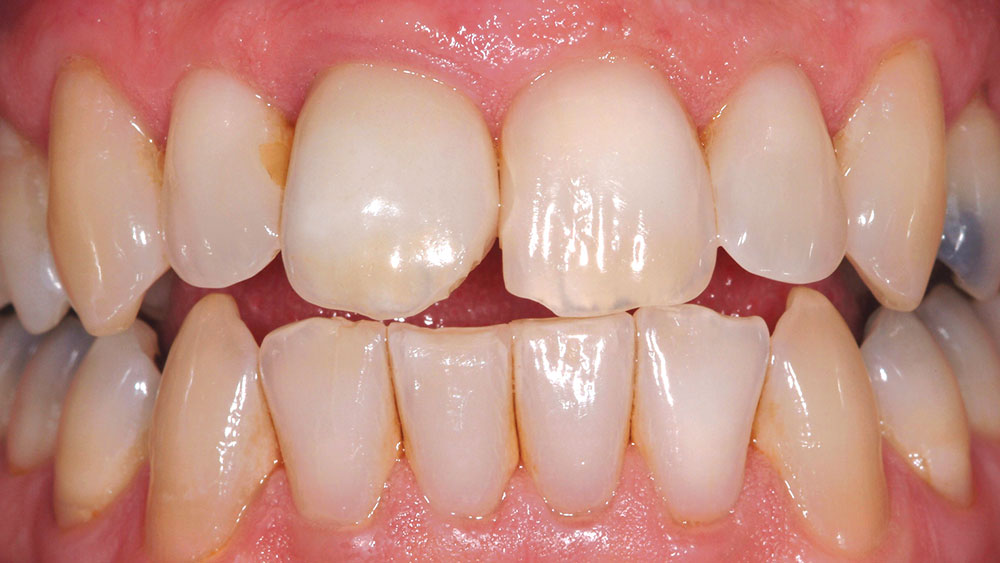 Optimizing Shade Match Using All-Ceramic and Composite Materials