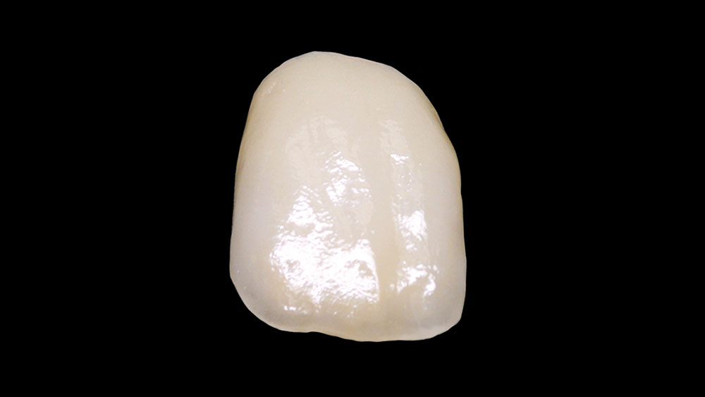 Optimizing Shade Match Using All-Ceramic and Composite Materials