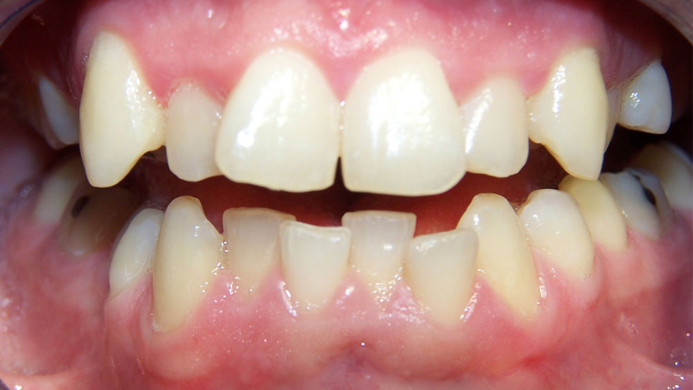 Six-Month Adult Aesthetic - Orthodontic Treatment