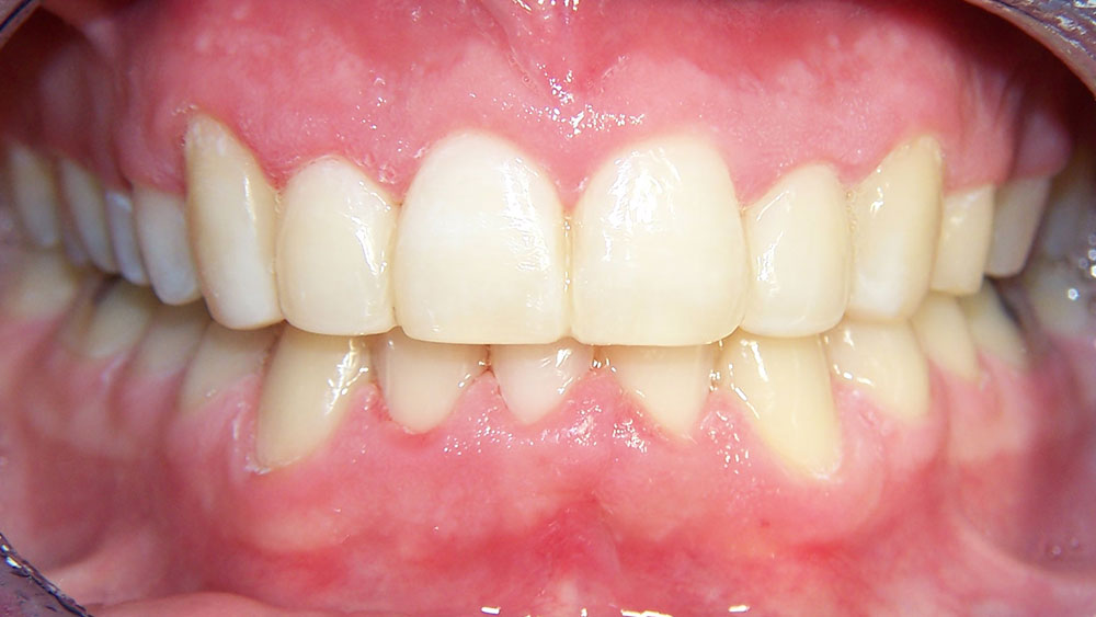 Six-Month Adult Aesthetic - Orthodontic Treatment
