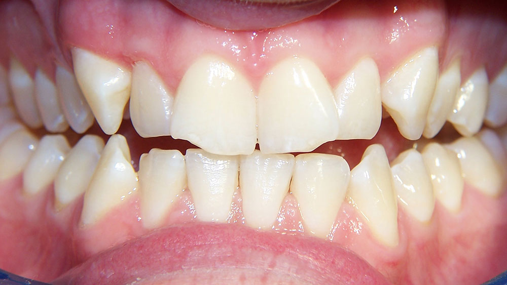 Six-Month Adult Aesthetic - Orthodontic Treatment