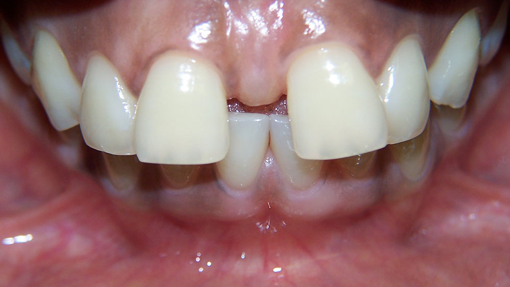 Six-Month Adult Aesthetic - Orthodontic Treatment