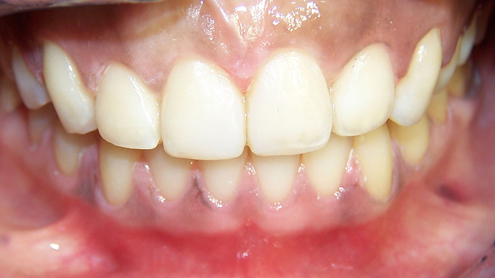 Six-Month Adult Aesthetic - Orthodontic Treatment