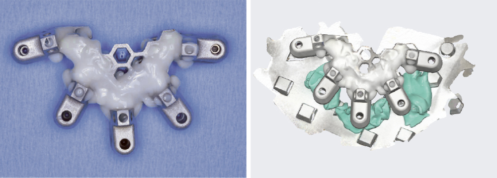 All-on-X Workflow Backed by Glidewell and ArchTracer™