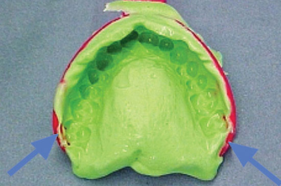 Identification and Correction of Common Impression Problems