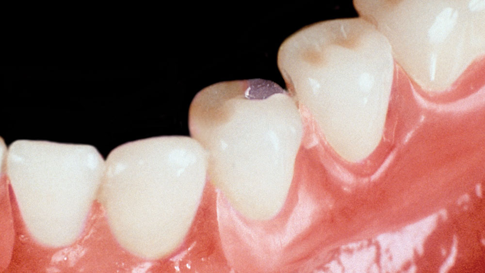 Valplast Clinical Indications