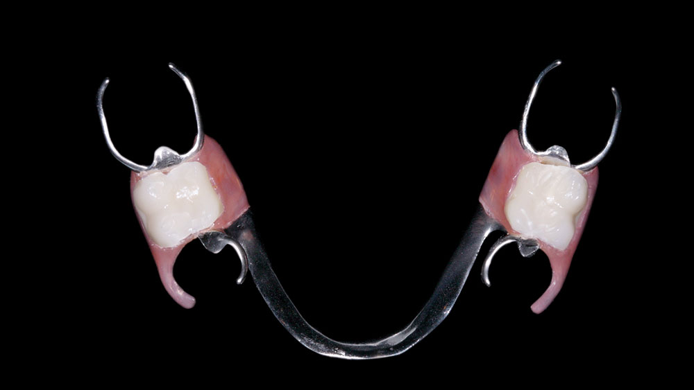 Valplast Clinical Indications