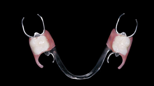 Valplast Clinical Indications