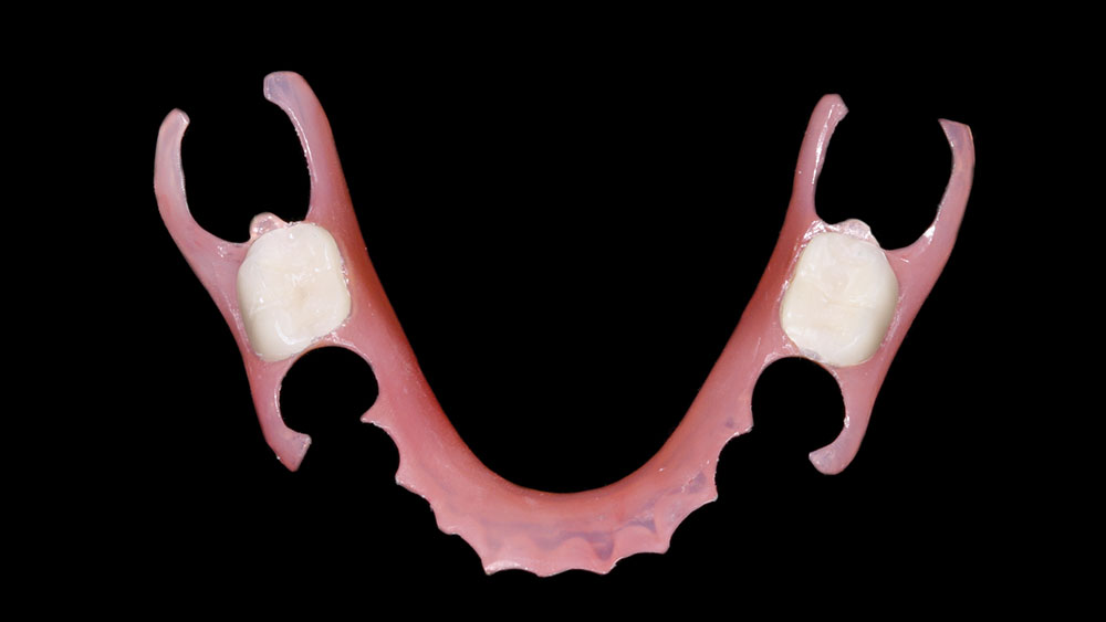 Valplast Clinical Indications