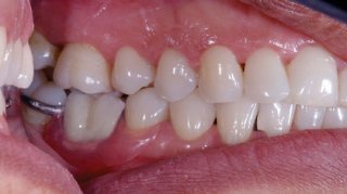 Valplast Clinical Indications