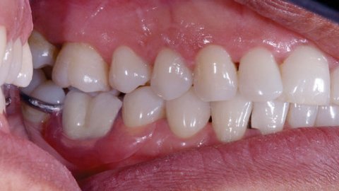 Valplast Clinical Indications