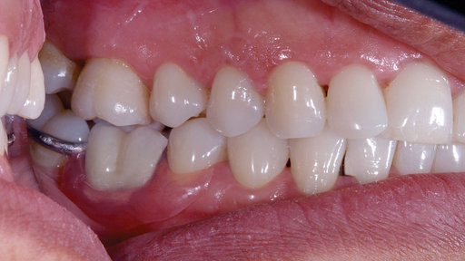 Valplast Clinical Indications