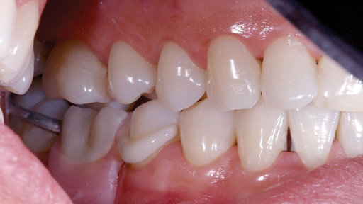 Valplast Clinical Indications