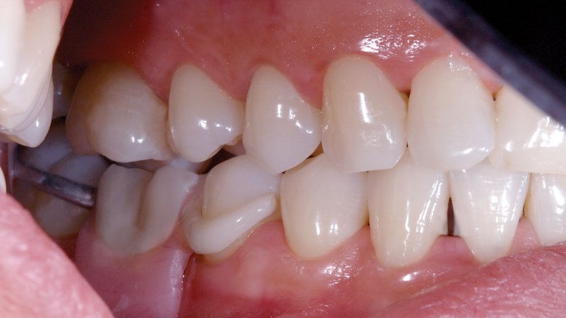 Valplast Clinical Indications