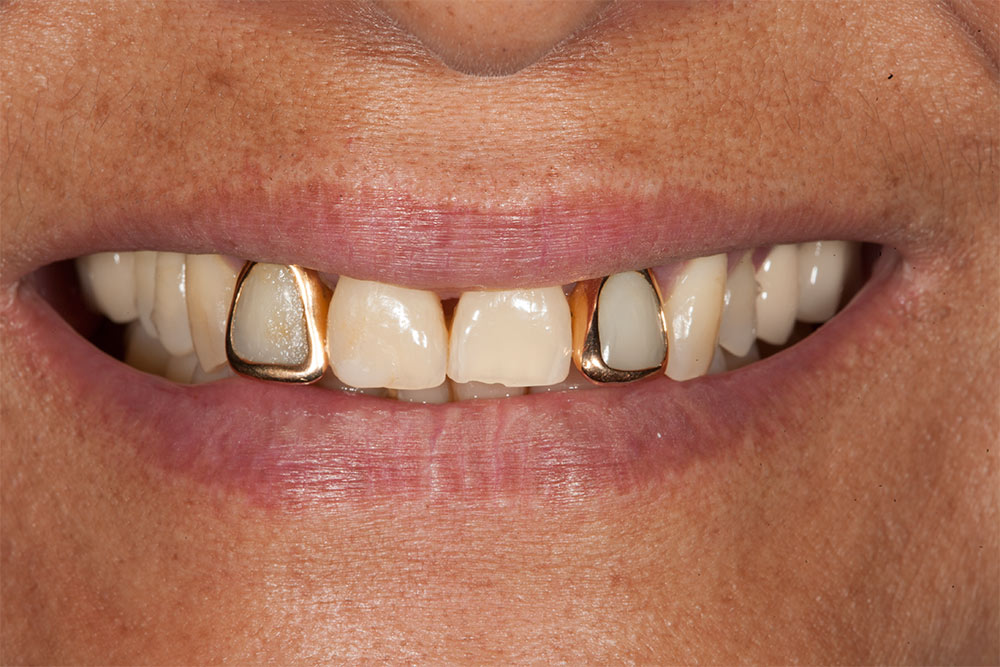 Reverse Preparation Technique