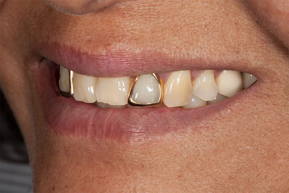 Reverse Preparation Technique