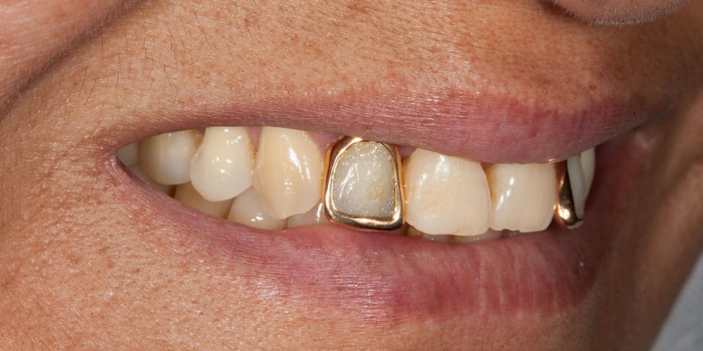 Reverse Preparation Technique