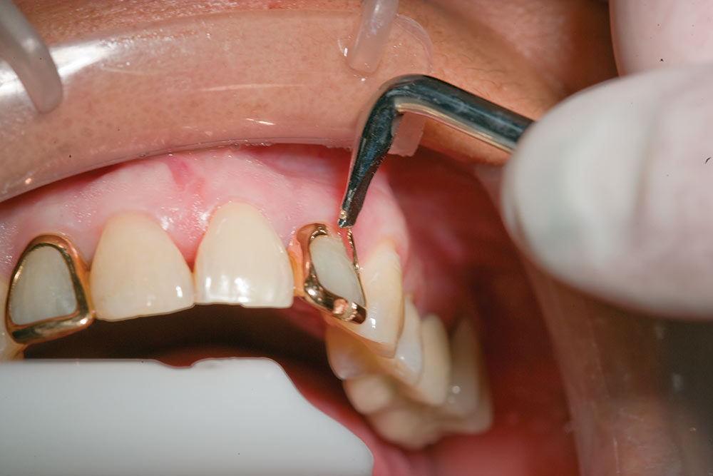 Reverse Preparation Technique