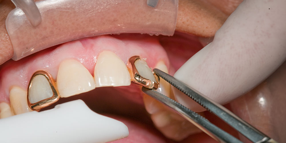 Reverse Preparation Technique