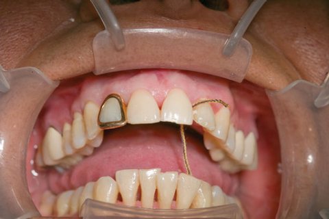 Reverse Preparation Technique