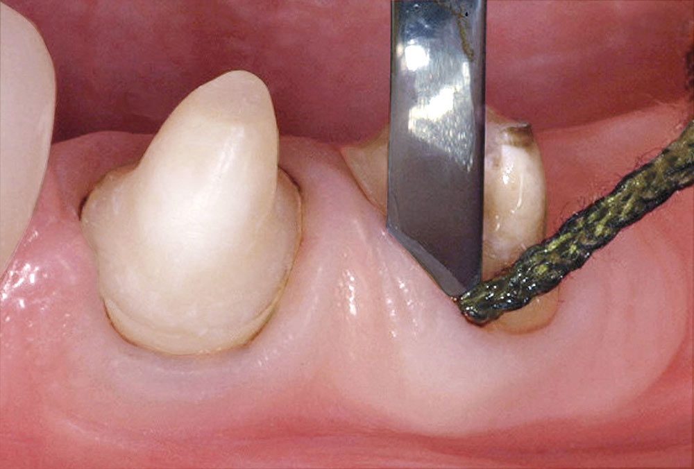 Taking the Perfect Impression