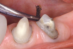 Taking the Perfect Impression