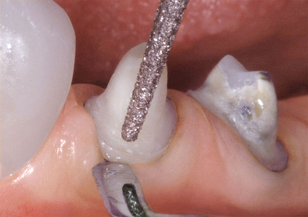 Taking the Perfect Impression