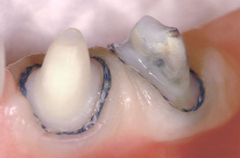 Taking the Perfect Impression