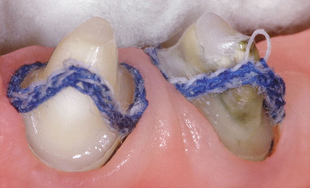 Taking the Perfect Impression