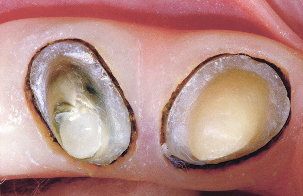 Taking the Perfect Impression