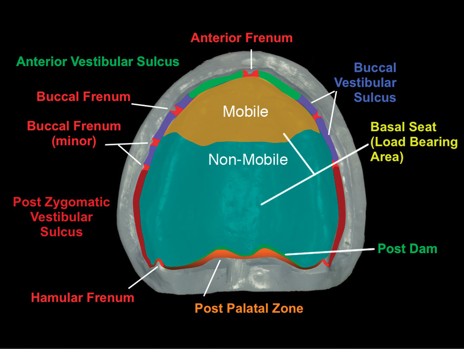 Building the Edentulous Impression - A Layering Technique Using ...