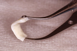 AlloDerm: An Effective Alternative to Palatal Donor Tissue for ...