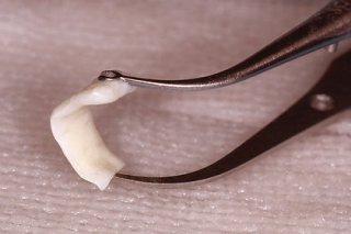 AlloDerm: An Effective Alternative to Palatal Donor Tissue for ...