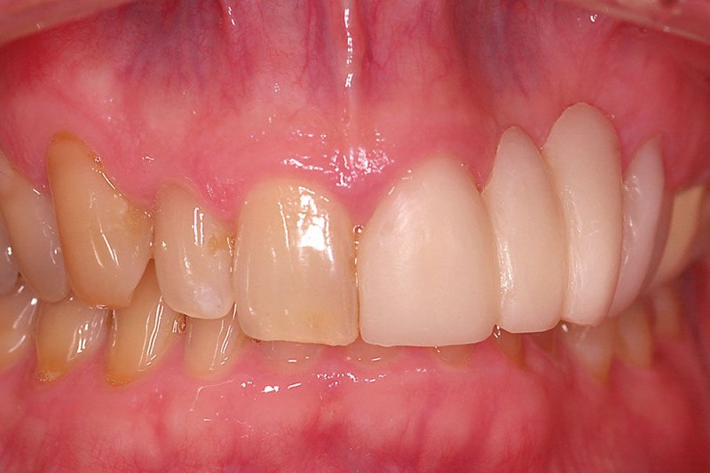 AlloDerm: An Effective Alternative to Palatal Donor Tissue for ...