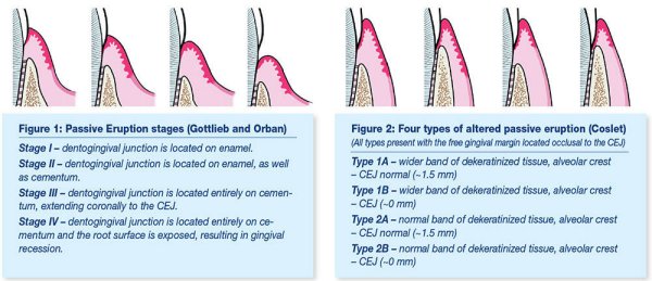 Altered Passive Eruption: Diagnosis and Treatment