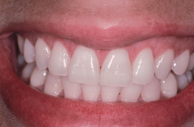 Altered Passive Eruption: Diagnosis and Treatment