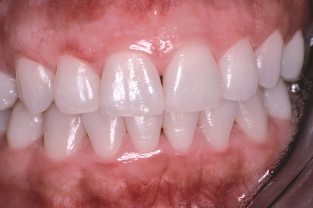 Altered Passive Eruption: Diagnosis and Treatment