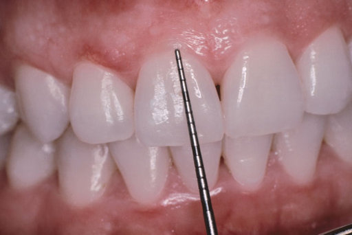 Altered Passive Eruption: Diagnosis and Treatment