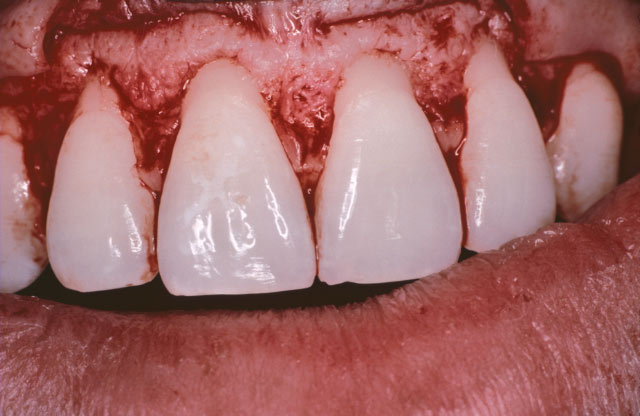 Altered Passive Eruption: Diagnosis and Treatment