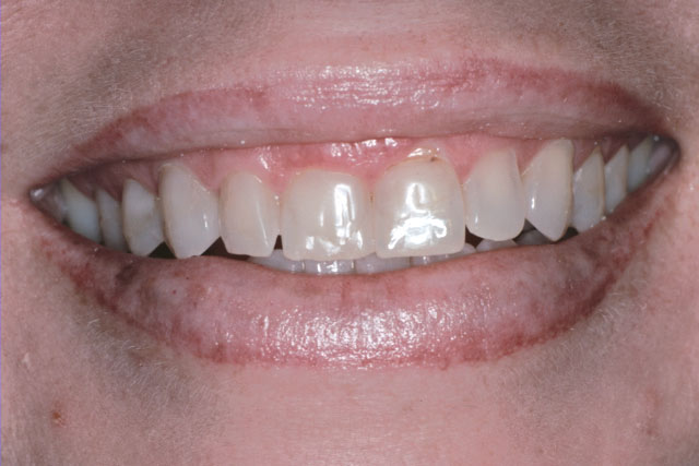 Altered Passive Eruption: Diagnosis and Treatment