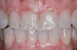 Altered Passive Eruption: Diagnosis and Treatment