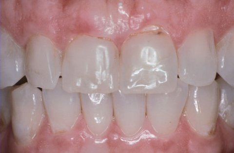 Altered Passive Eruption: Diagnosis and Treatment