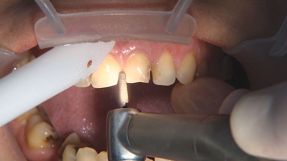 Anterior Procera Zirconia Crowns with No-Prep Vivaneers