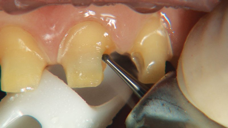Anterior Procera Zirconia Crowns with No-Prep Vivaneers