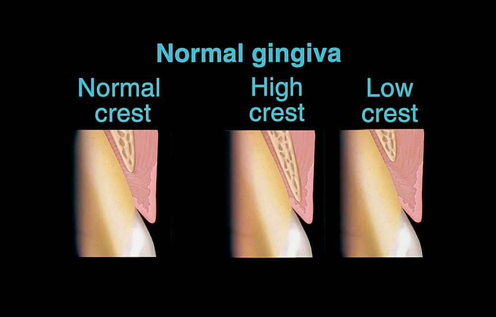 Clinical Techniques in Prosthodontics: Relationship of the Periodontium ...