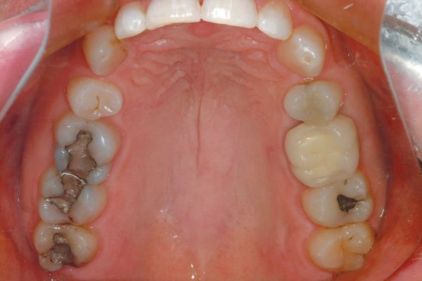 Simply Beautiful - A Venus Reconstruction of a Class II Malocclusion