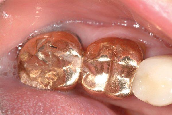 Clinical Technique for Core Buildups