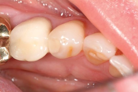 Clinical Technique for Core Buildups